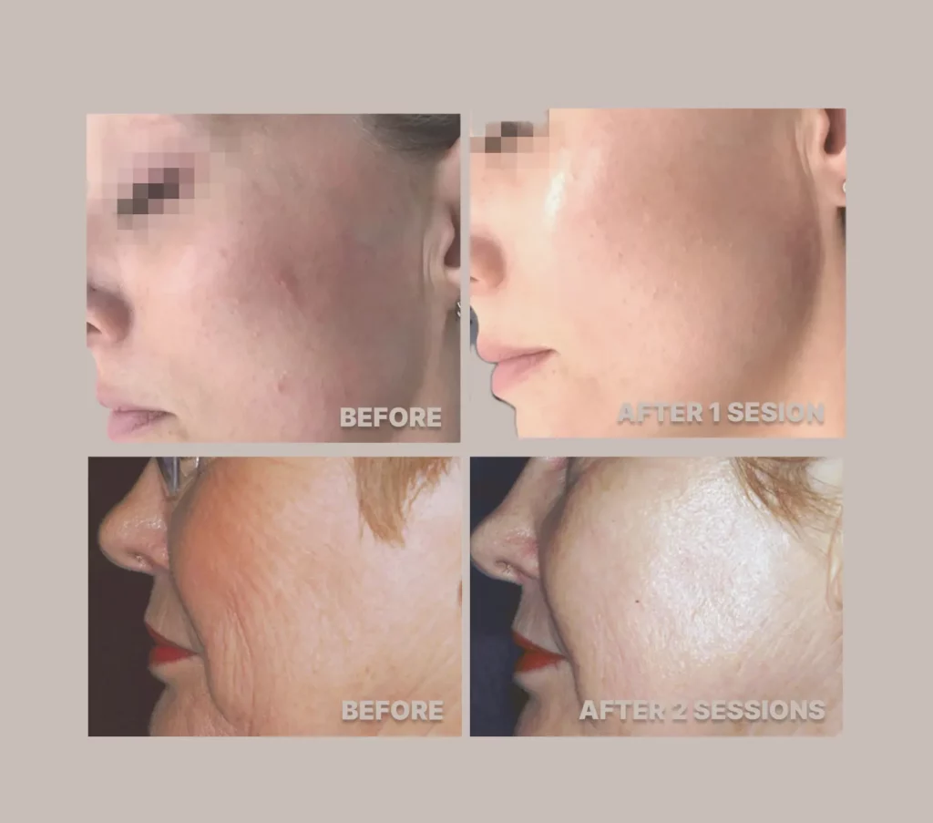Laser for Facial Redness | SEV Laser