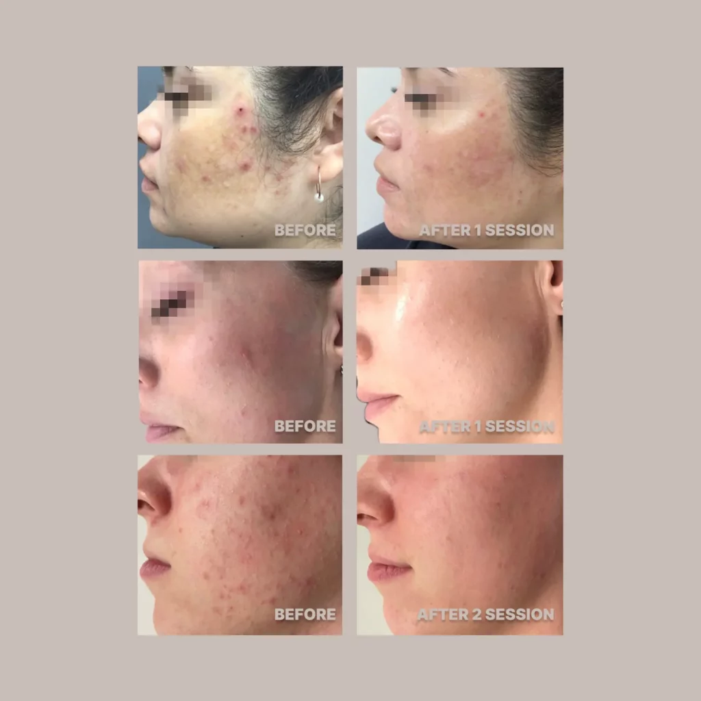 Best Laser Treatment for Acne | Laser Facial for Acne | SEV