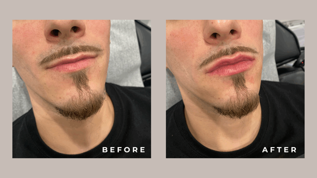 Men Lip Filler: Complete Guide for Men | SEV