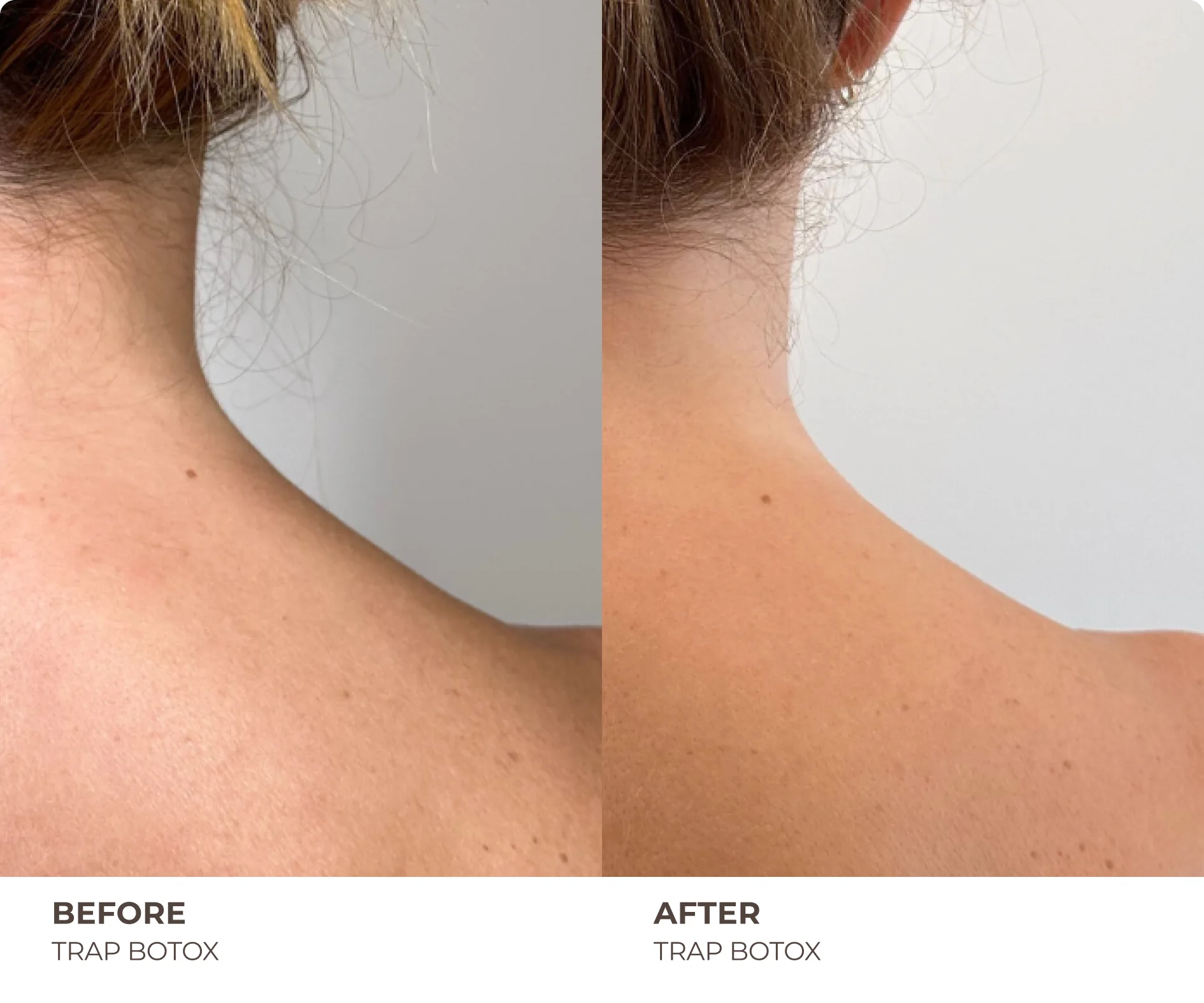 Cosmetic Injections | Personalized Injectables | SEV Laser