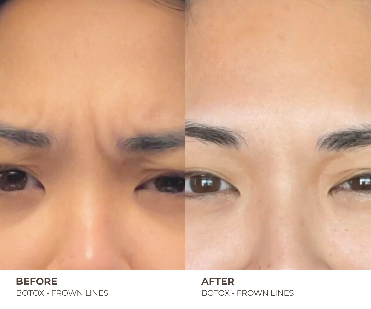 Botox Injections | Personalized Botox Treatment | SEV Laser