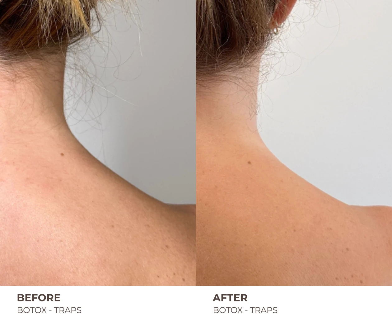 Botox Injections | Personalized Botox Treatment | SEV Laser