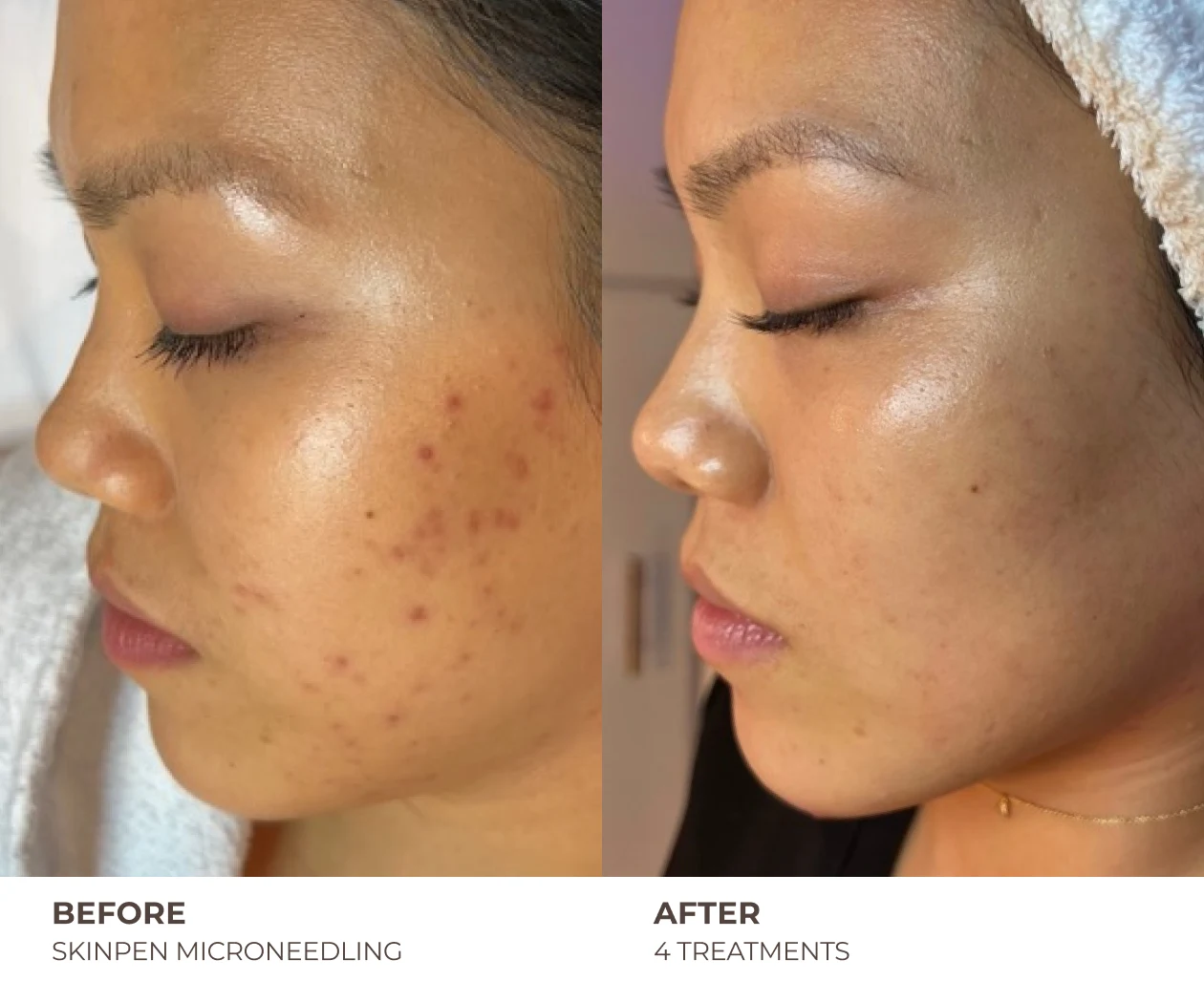 SkinPen Microneedling | Smooth & Renew Your Skin | SEV Laser