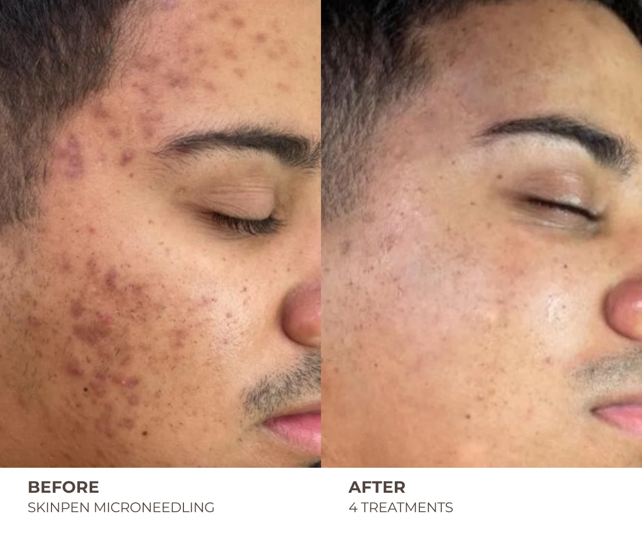 SkinPen Microneedling | Smooth & Renew Your Skin | SEV Laser