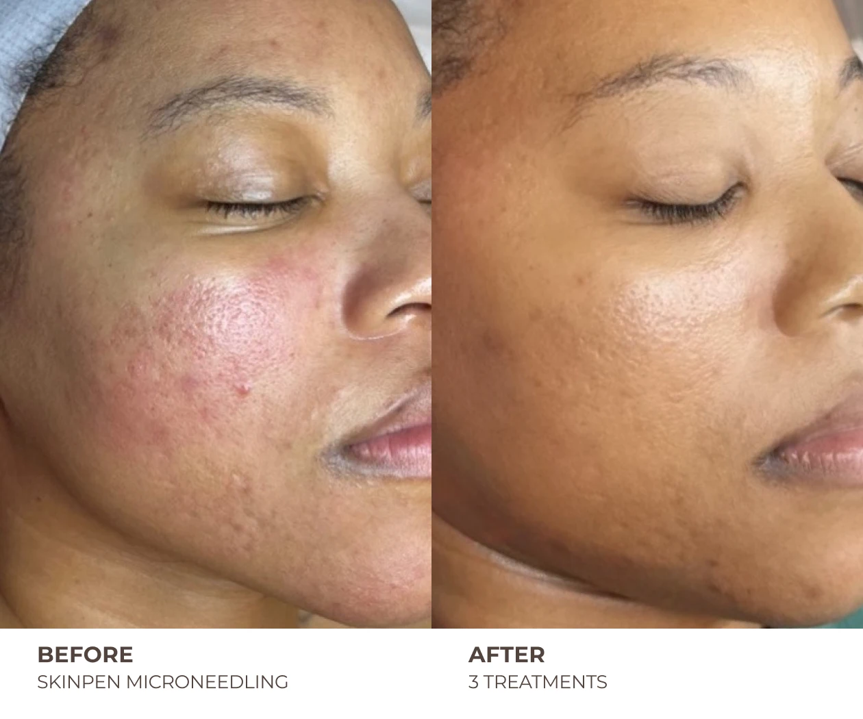 SkinPen Microneedling | Smooth & Renew Your Skin | SEV Laser