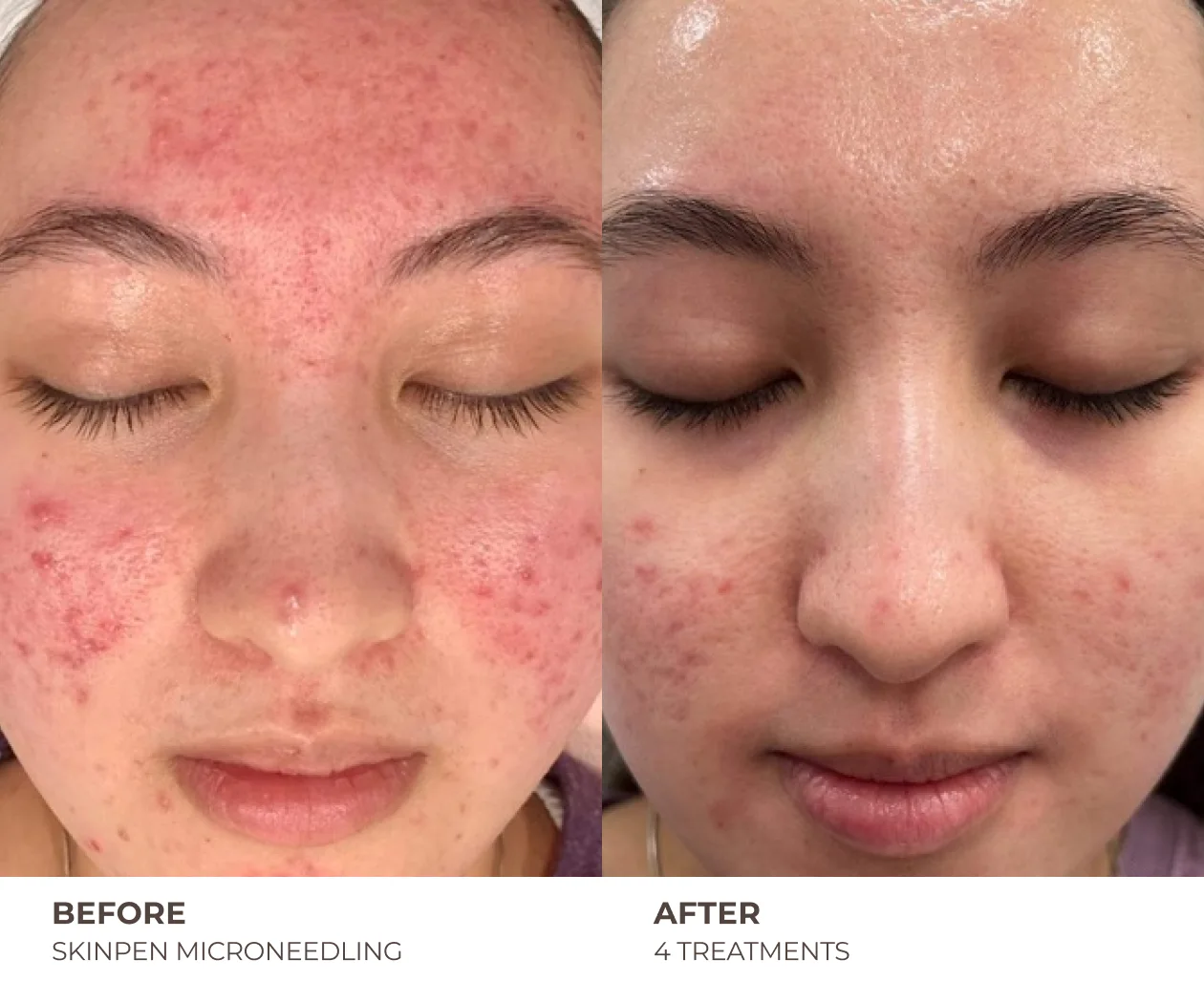 SkinPen Microneedling | Smooth & Renew Your Skin | SEV Laser